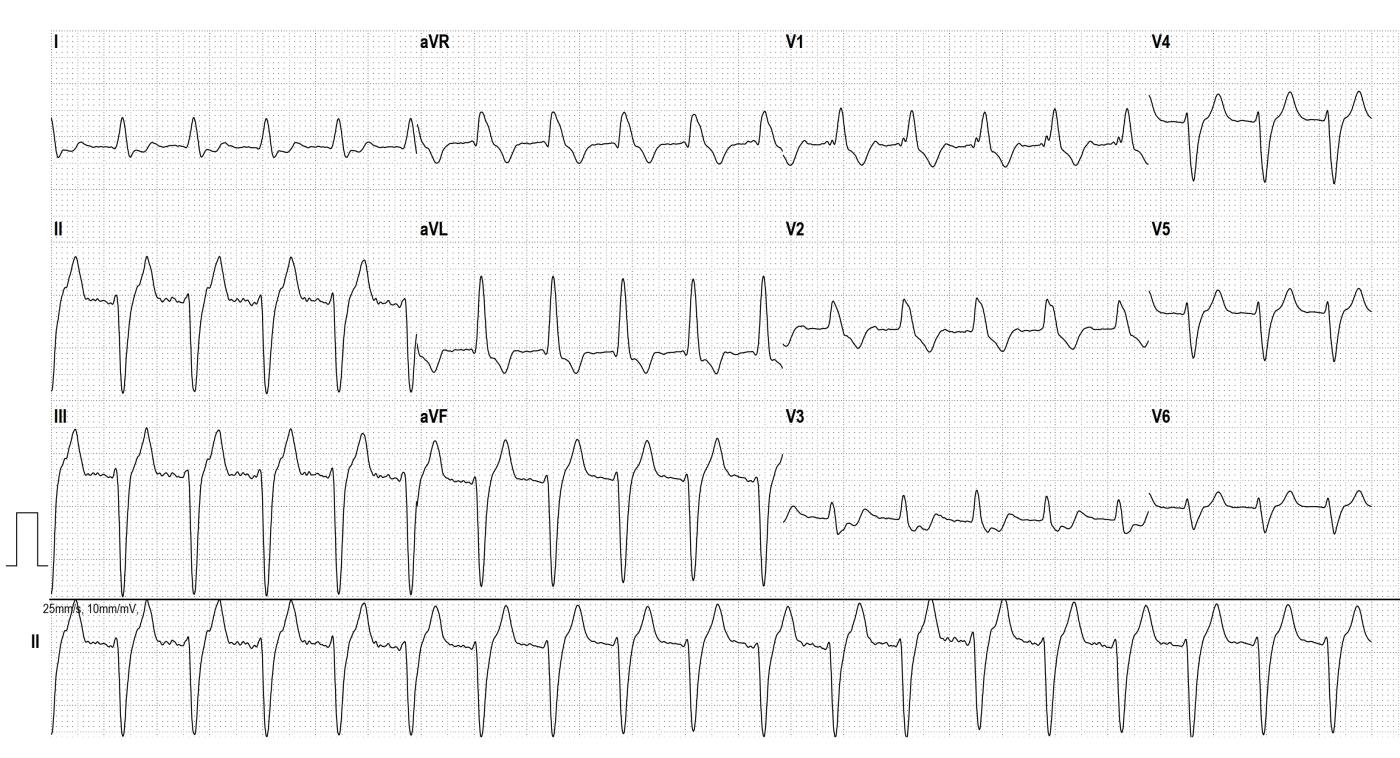 Atrial Flutter With Right Bundle Branch Block And Left Anterior